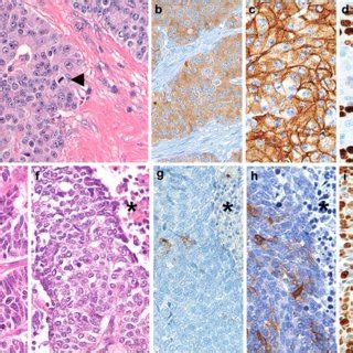 Histology Of Well Differentiated Neuroendocrine Cancer A C Low Grade