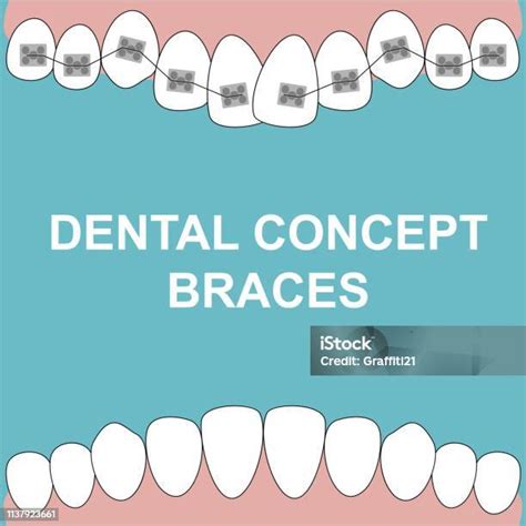 배너 상단 중괄호 치아 그림 파란색 배경에 벡터 치과 개념입니다 건강관리와 의술에 대한 스톡 벡터 아트 및 기타 이미지 건강관리와 의술 귀여운 금속 Istock