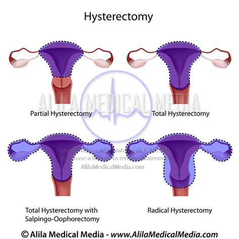 Total Hysterectomy