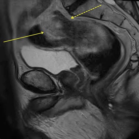 Pdf Colorectal Intussusception Secondary To Primary Rectal Melanoma A Novel Case Report