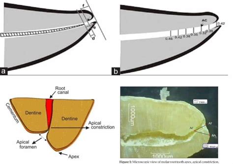 Ex Vivo Comparison Of The Accuracy Of Six Apex Locators In Working Length Determination