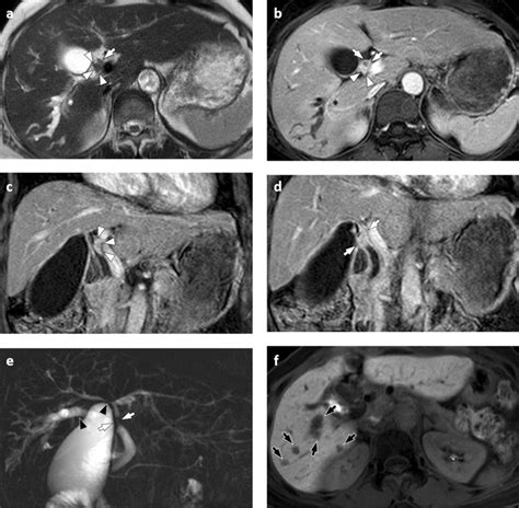 A 58 Year Old Woman With Perihilar Cholangiocarcinoma In The Non R0