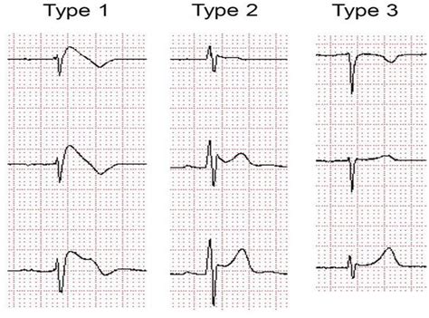Brugada Type Ecg Shift Ecg Electrocardiogram Image Source