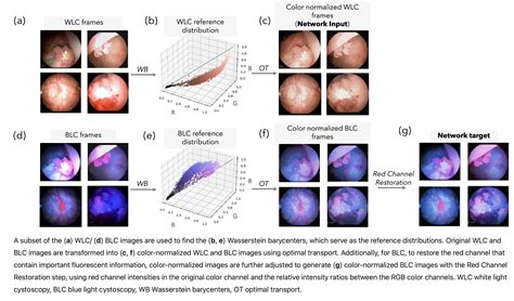 Low Cost And Label Free Blue Light Cystoscopy Through Digital Staining Of White Light Cystoscopy
