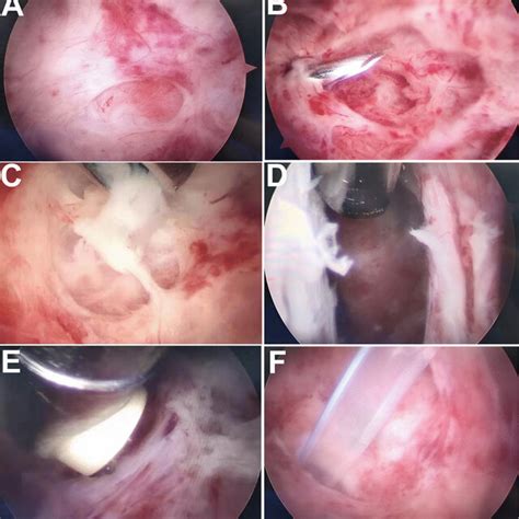 Endoscopic Cleansing Of The Abscess Cavity A The Endoscopic View Of