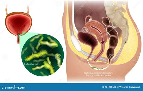Abacterial Cystitis Stock Illustrations 1 Abacterial Cystitis Stock