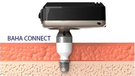 Tipos De Implante Baha Implante Coclear Valencia