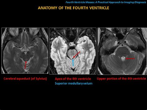 Fourth Ventricle Mri