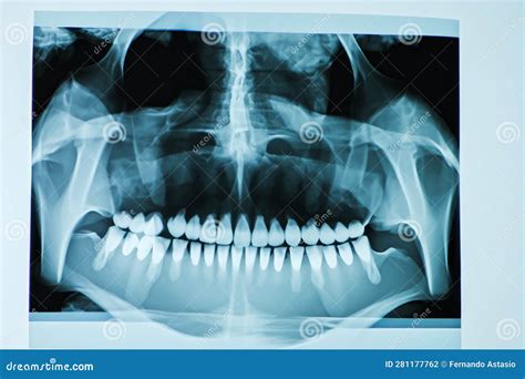 X Ray X Ray Of Head Foot Head Mouth Ribs And Hands Bone Scan Body Injury X Ray Analysis