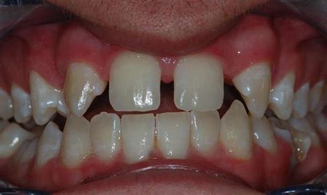 Before And After Photos Mini Implants Gallery Harris Park Nsw