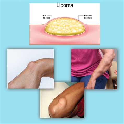 Exploring Lipomas Causes Symptoms And Treatment Options