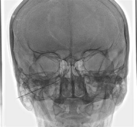 Sphenopalatine Nerve