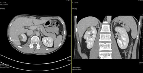 Reviews Of The Medtronic Emprint Hp Ablation System