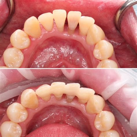 Periodontal Splint — Clean Teeth Dental