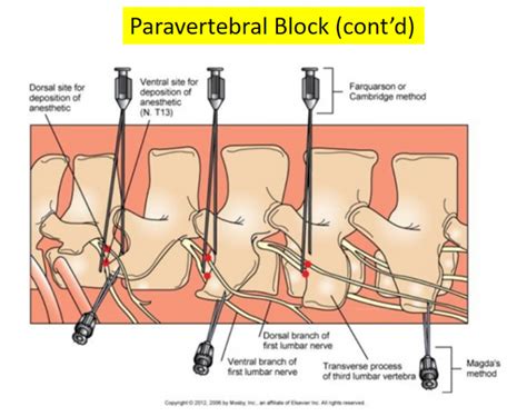 Local Anesthetic For Paravertebral Block At Rosie Halsey Blog