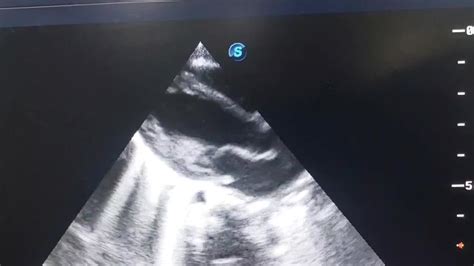 Azza Makram On Linkedin Arcade Mitral Valve