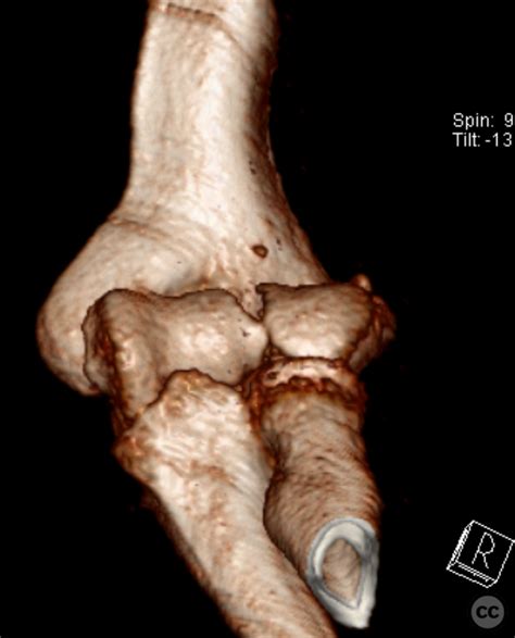 Dubberly 3 4 Shear Plus Comminuted Trans Condylar Trochlear Fracture