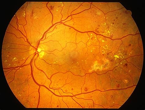 Severe Npdr Retina Image Bank