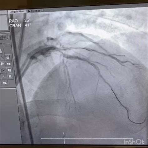 Saeed Amiripouya On Linkedin What Is Your Opinion About Haziness In Diagonal Ostium In Final