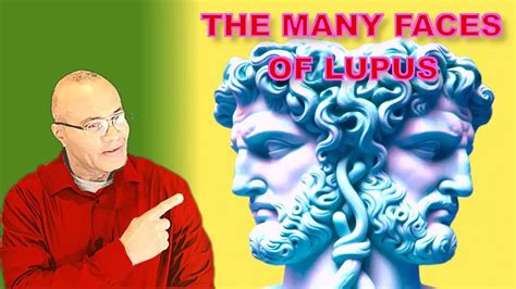 Diagnosing Lupus A Story Of Mystery Symptoms And Survival