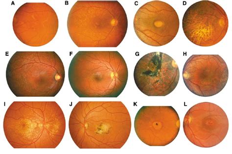Ophthalmoscopic Phenotypes Of Patients Affected With Molecularly