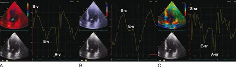 Assessment Of Left Atrial Size And Function Thoracic Key