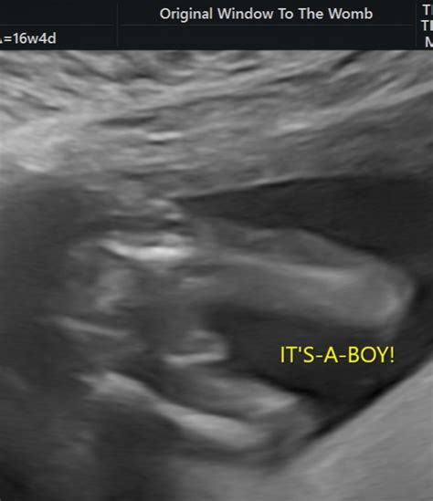 Gender Scan 15 Wks 3 Days