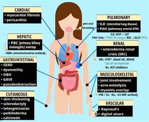 Explore Benefits Of HSCT Treatment For Scleroderma Systemic Sclerosis