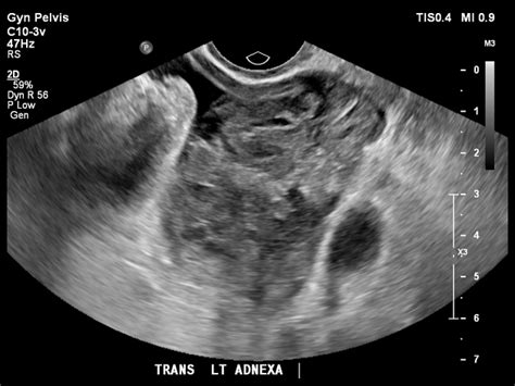 Ruptured Ectopic Pregnancy Ultrasound