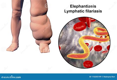 Leg Of A Person With Elephantiasis Lymphatic Filariasis Stock