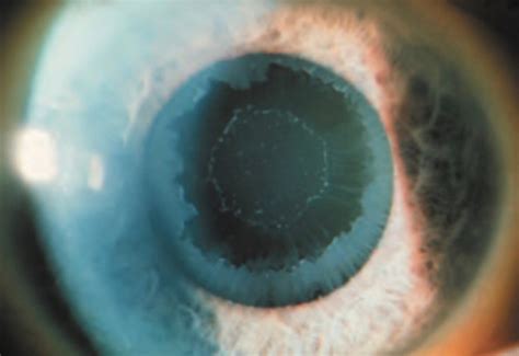 Glaucoma Flashcards Quizlet