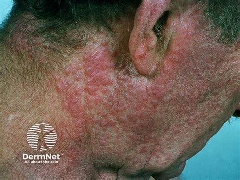 Chronic Actinic Dermatitis Image