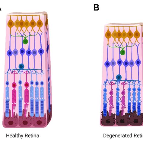 Cartoon Schematic Of A Healthy Retina In Comparison To A Degenerating Download Scientific