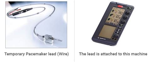 When The Need For TPI Is Over It Is Taken Out From The Body If PPI Permenant Pacemaker