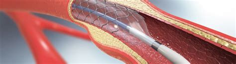 What Is An Extracranial Intracranial Bypass Nysi