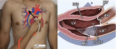 Echocardiogram Echo Flashcards Quizlet