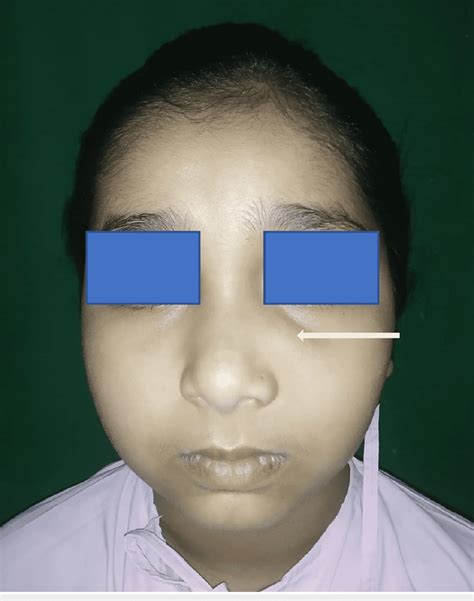 Swelling Present Over The Left Maxillary Sinus In The Nasofacial Region Download Scientific