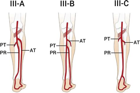 Popliteal Artery Anatomy Branches Location And Course