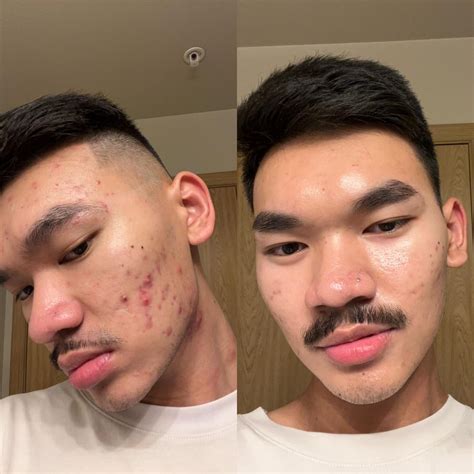 Is Bp Really Necessary With Clindamycin And Tretinoin R Acne