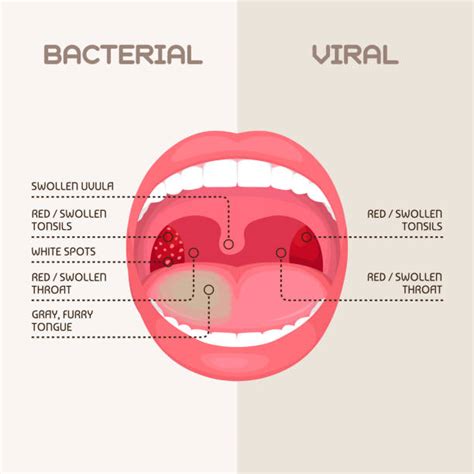 Best Tonsillitis Illustrations Royalty Free Vector Graphics And Clip Art Istock