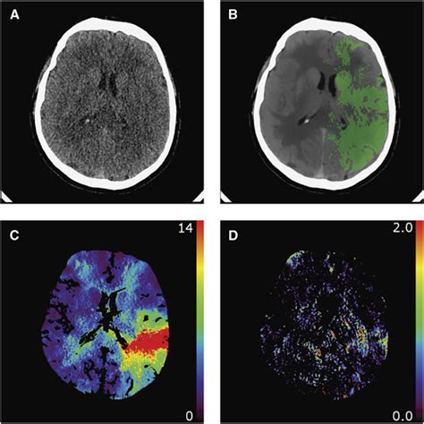 An Example Of A An Unfiltered Computed Tomography Ct Perfusion