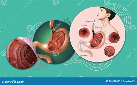 Digestive Endoscopy Or Gastroscopy Performing A Gastroscopy Procedure