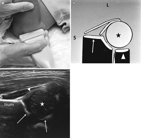 The Pelvis And Hip Congenital And Developmental Conditions Radiology Key