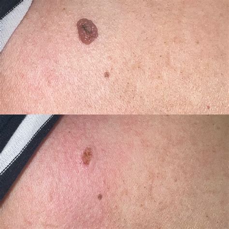 Benign Lesion Removal At Skiin Laser Clinic