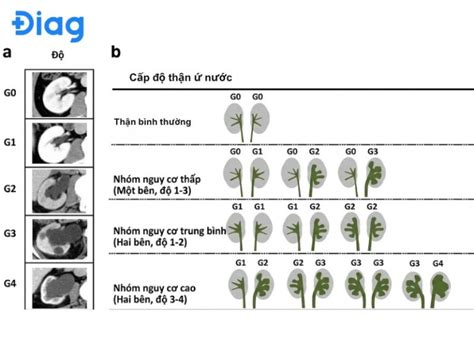 Phân độ Thận ứ Nước Và Cách Chẩn đoán Trên Ct