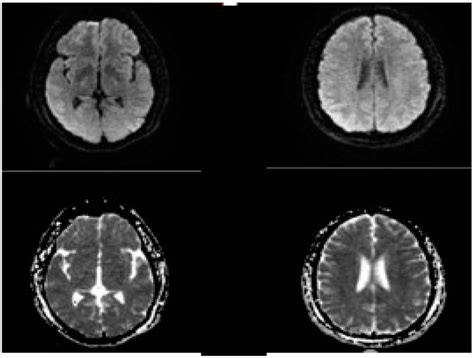 Post Procedure Of Mri Brain In The Same Patient Presenting With Left Download Scientific