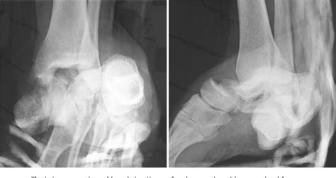 Table 1 From Open Talar Dislocations Without Associated Fractures