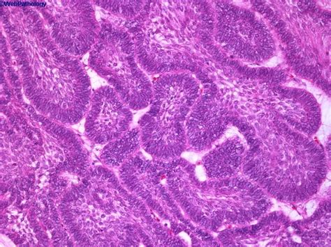 Ameloblastoma Basaloid Pattern