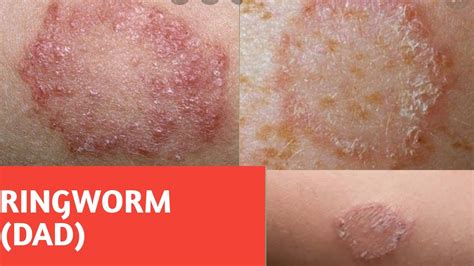 Ringworm Pictures How To Identify Ringworm On Your Body
