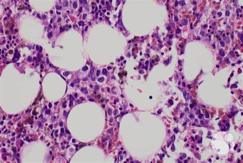 Panel B 40x Cells Are Large With Large Pleomorphic Nucleus Abundant